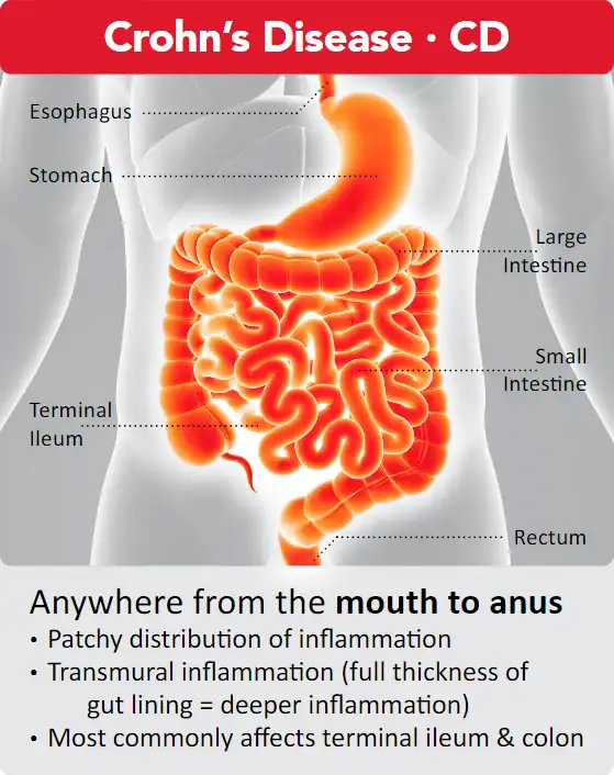 Crohns Disease Colonoscopy, Inflammatory Bowel Syndrome