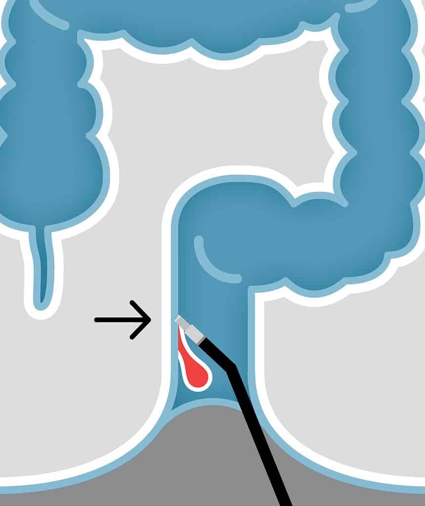 IRC Infrared Coagulation | Gastroenterology of the Rockies